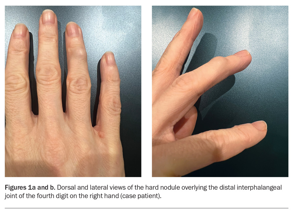 Rheumatoid Arthritis Nodules On Fingers